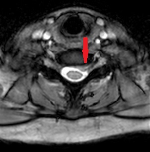 C6-C7 HNP Axial MRI - Shim Spine