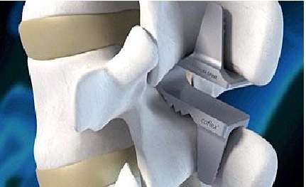 Surgery for Recurrent Disk Herniations - Shim Spine