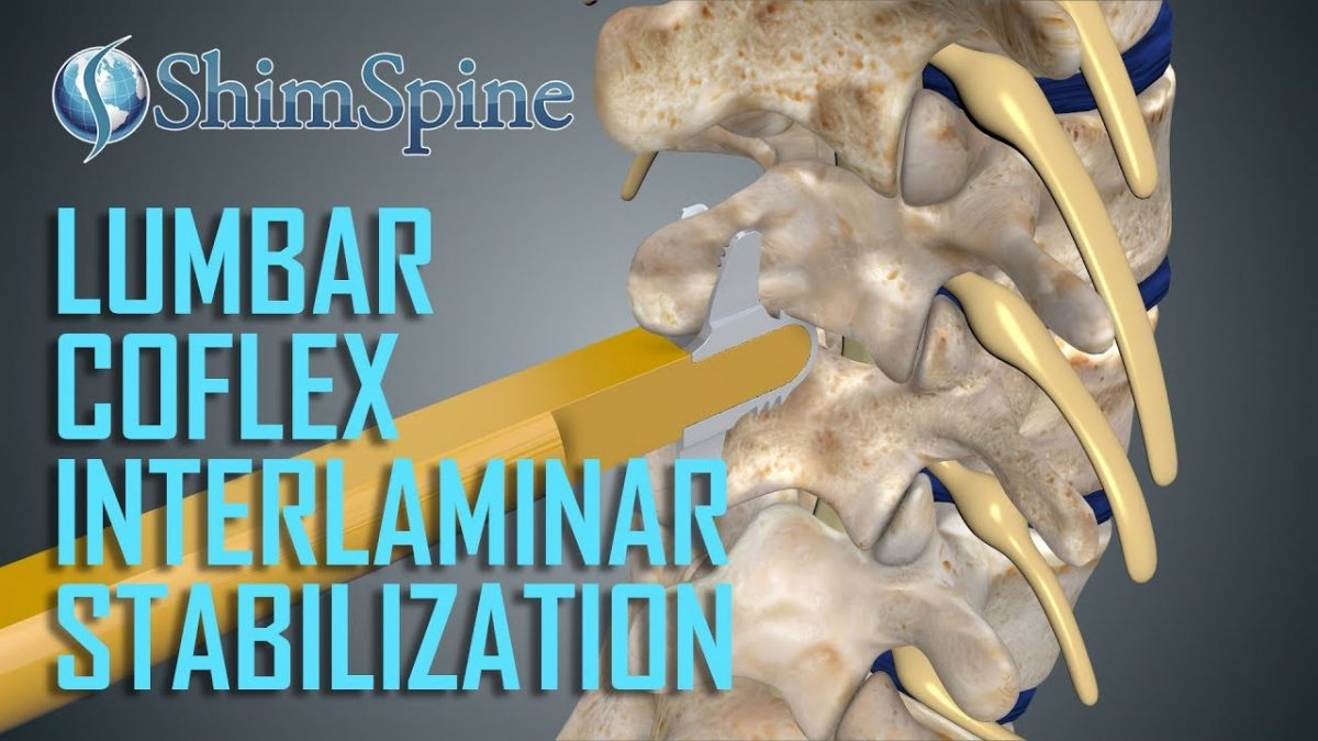 Lumbar Coflex Interlaminar Stabilization Surgery - ShimSpine