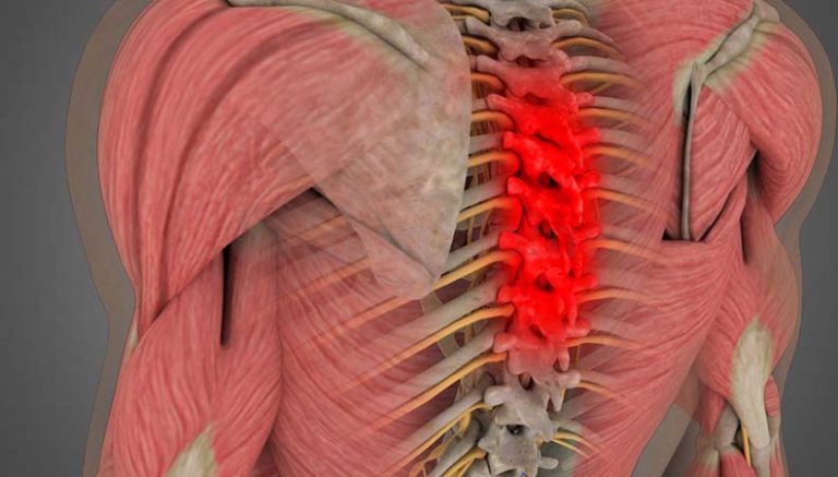 Thoracic Spinal Stenosis - ShimSpine