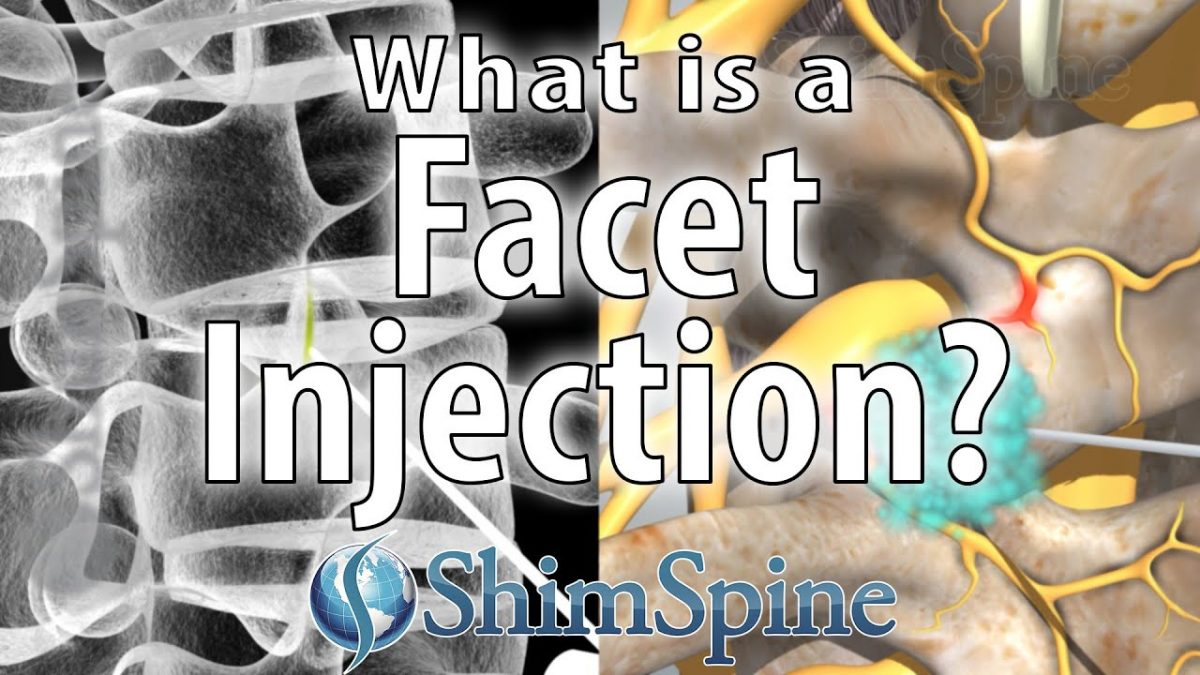 What is a Facet Injection? - ShimSpine