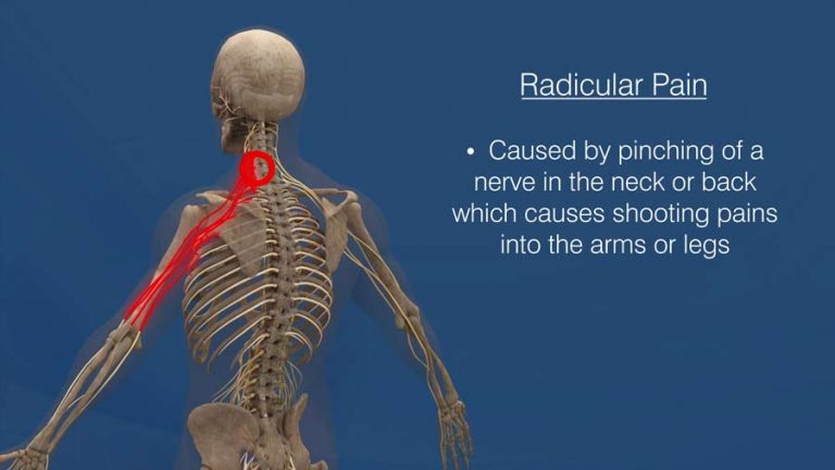 Radicular-pain - ShimSpine