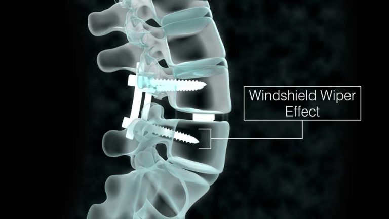 windshield-wiper-effect - ShimSpine
