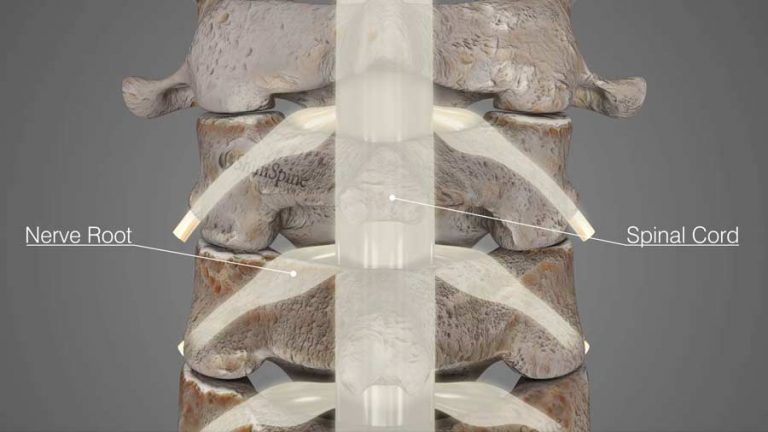 Posterior Cervical Foraminotomy - ShimSpine