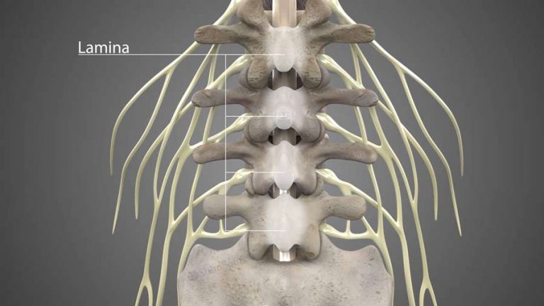 Lumbar Laminectomy - ShimSpine