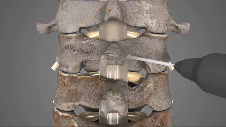Posterior Cervical Foraminotomy - ShimSpine