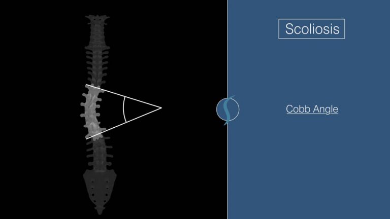 cobb-angle - ShimSpine